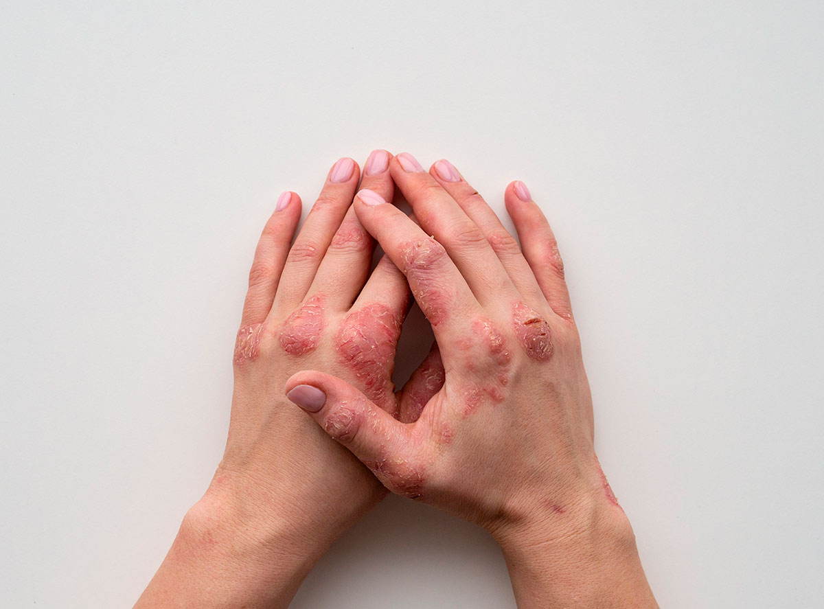 Psoriasis: causas y tratamiento | Dermus